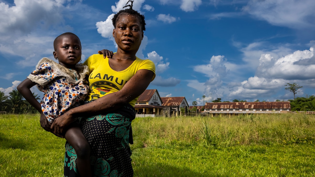 A deadly monkeypox variant is surging in Central Africa