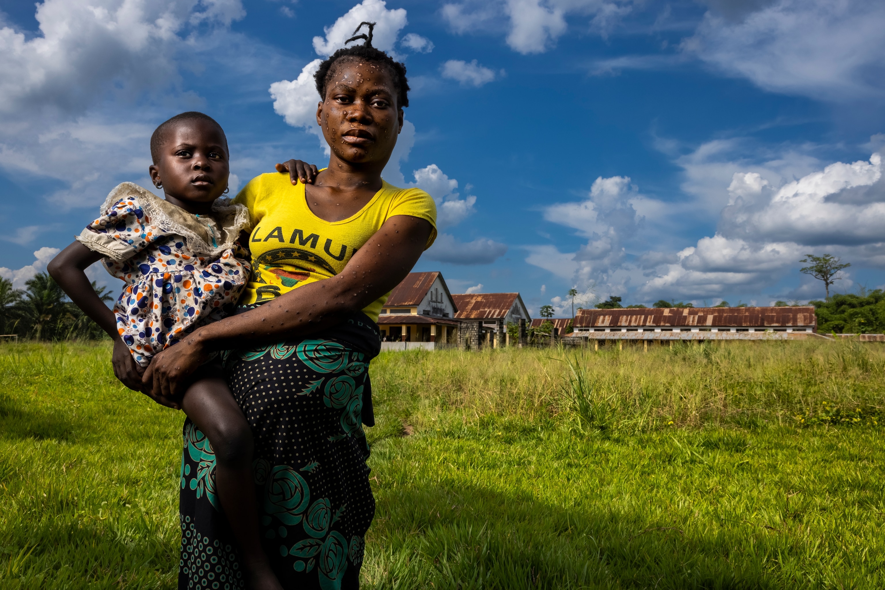 A deadly monkeypox variant is surging in Central Africa