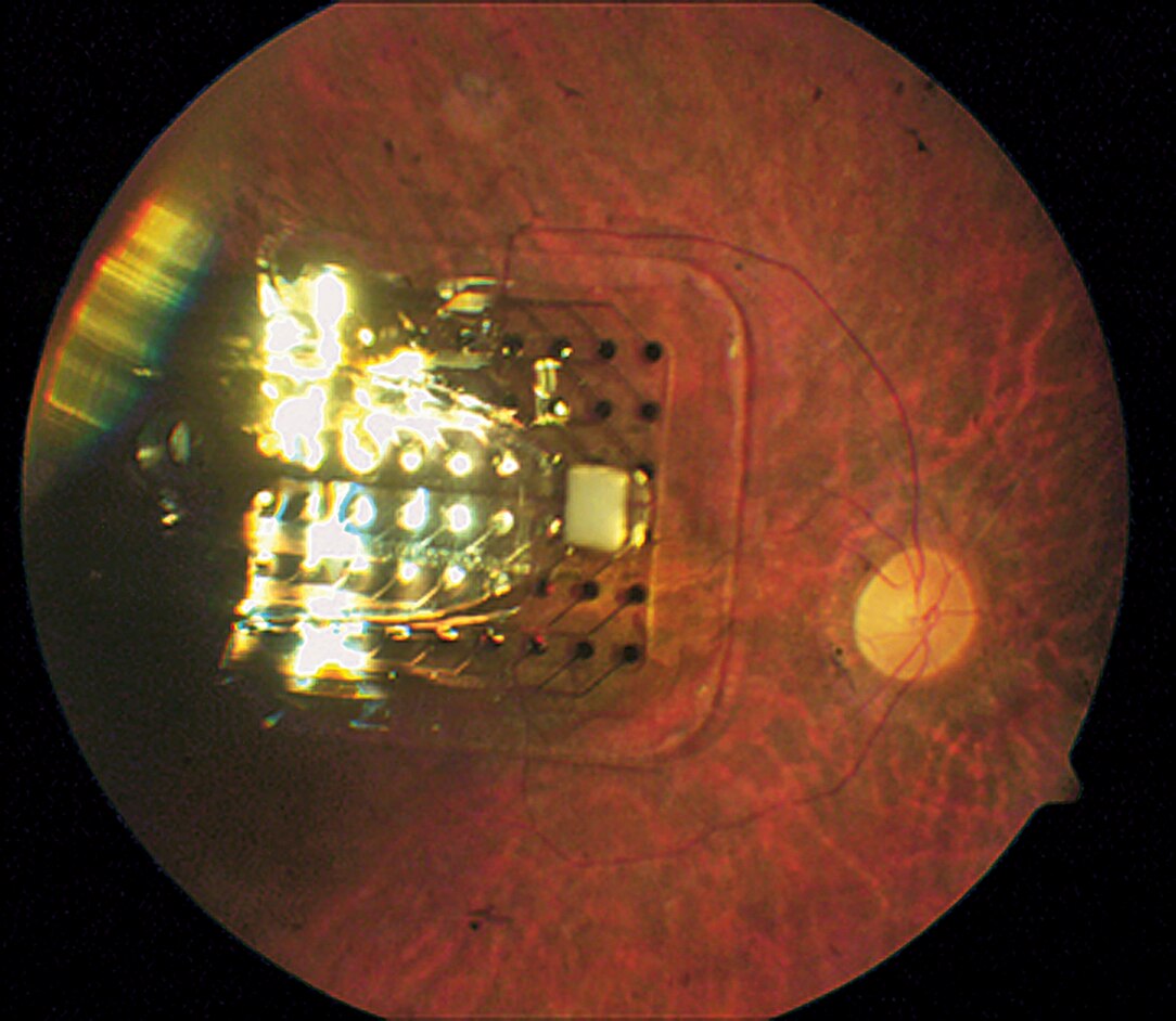 Bionic Arm National Geographic