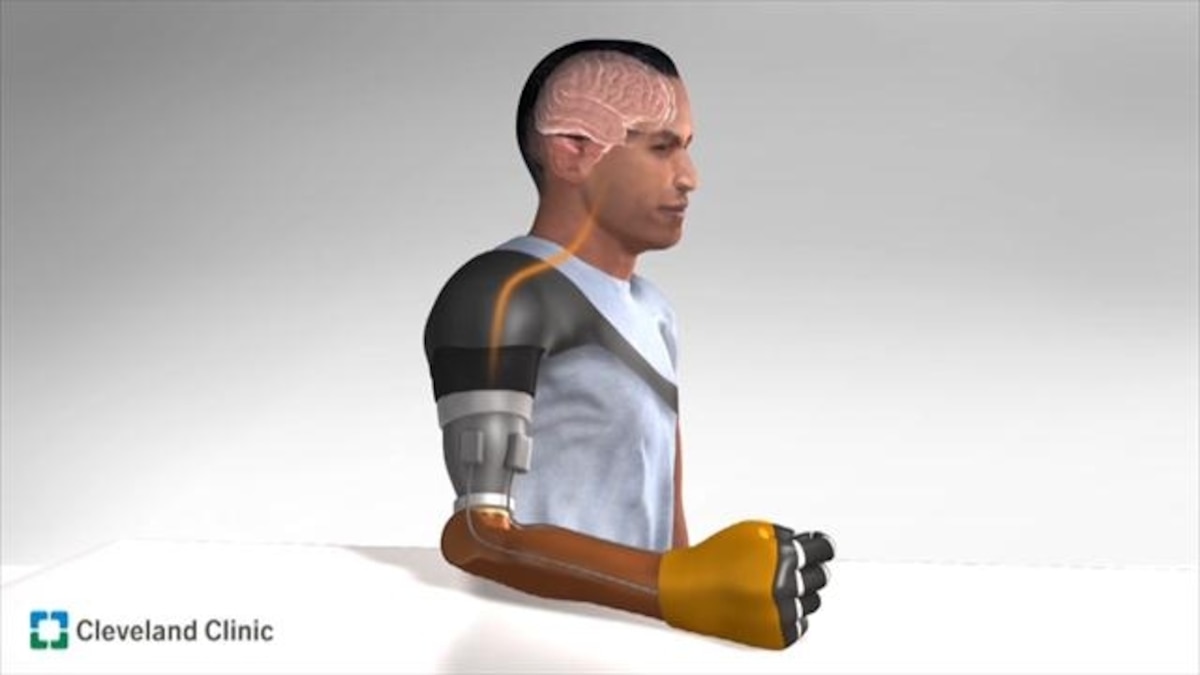 Sensation of Movement Recreated in Amputees' Robotic Arms | National ...
