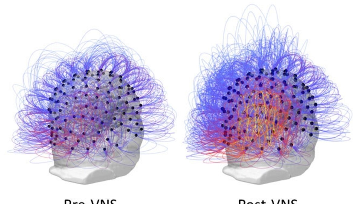 Man in Vegetative State for 15 Years Responds to Nerve Stimulation ...