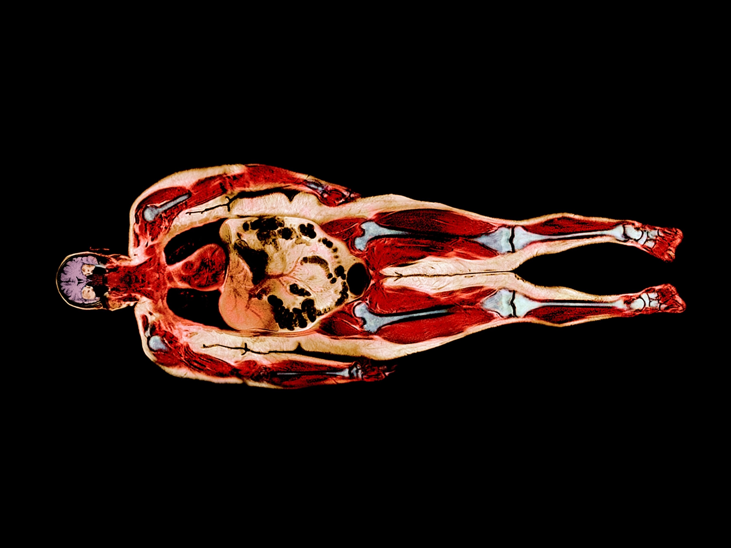 What is brown fat—and how does it control obesity?