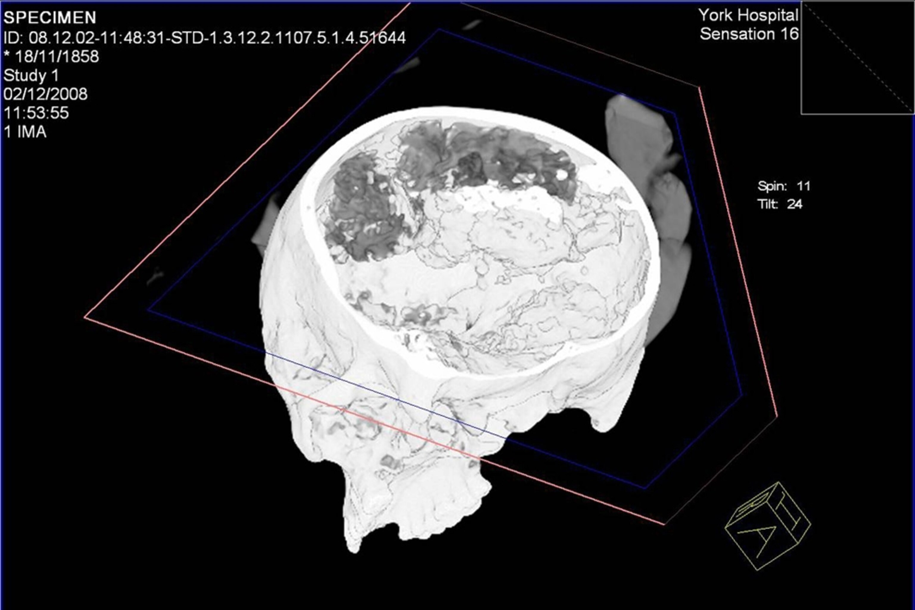 Pictures: 2,500-Year-Old Brain Examined