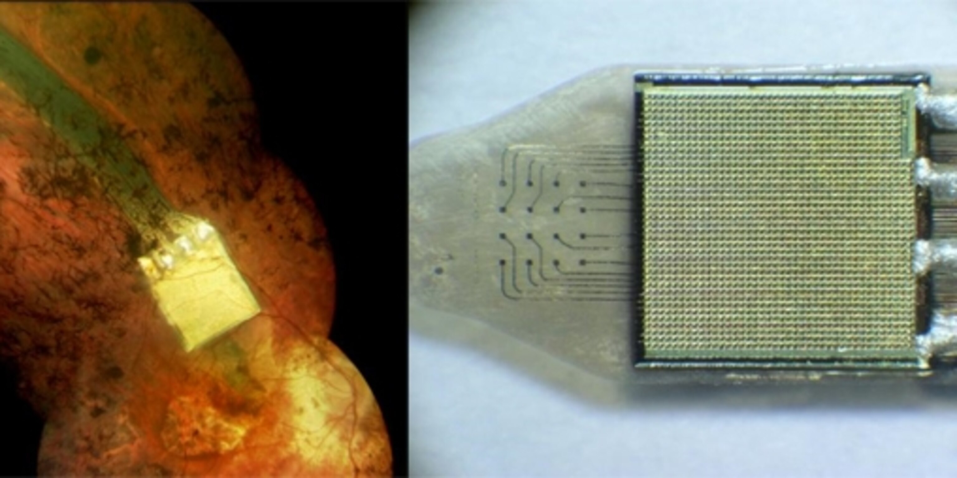 Retinal implant partially restores sight in blind people
