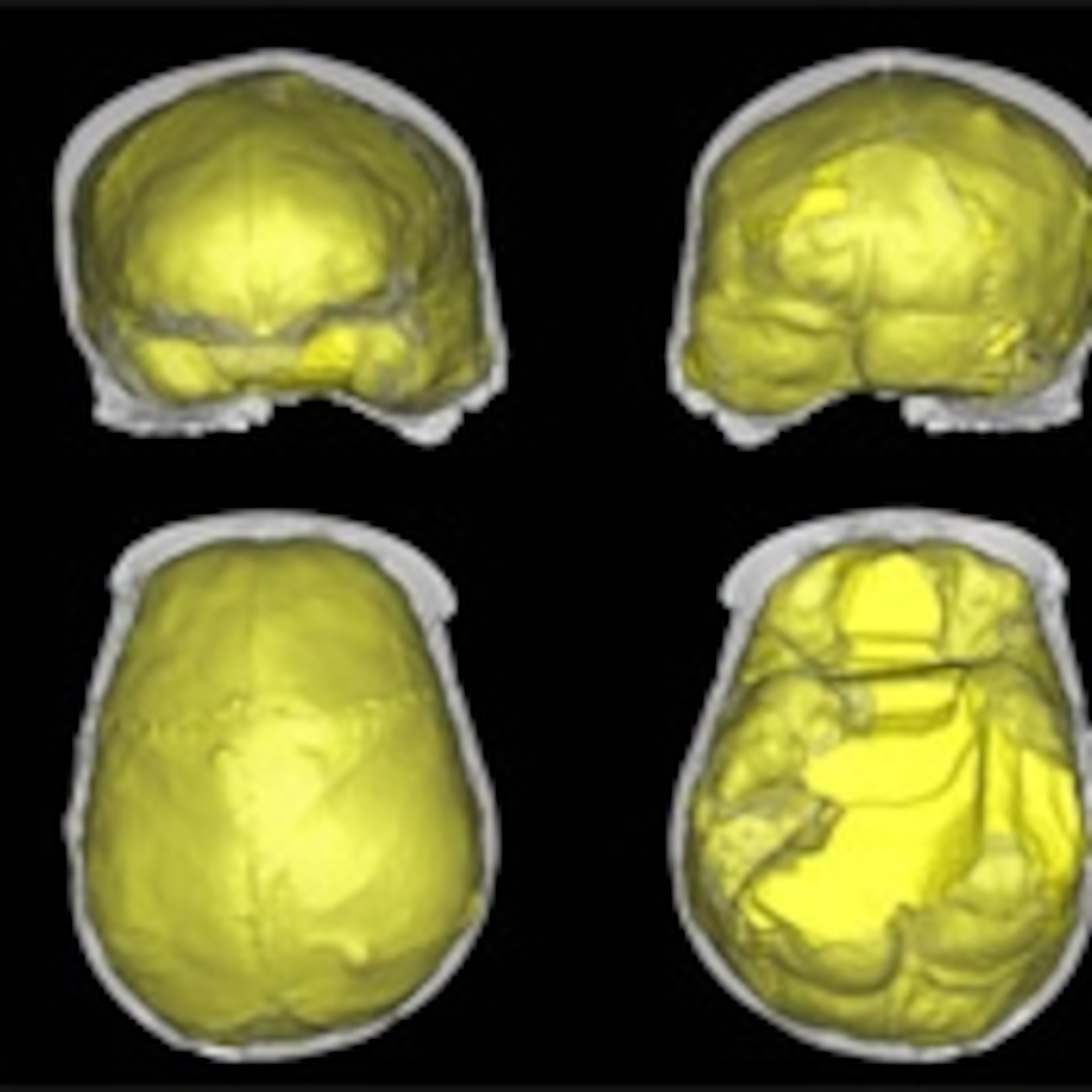 Deformed skull of prehistoric child suggests that early humans cared ...