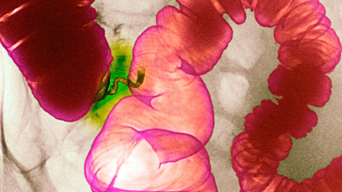 Why women are more likely to have IBS | National Geographic