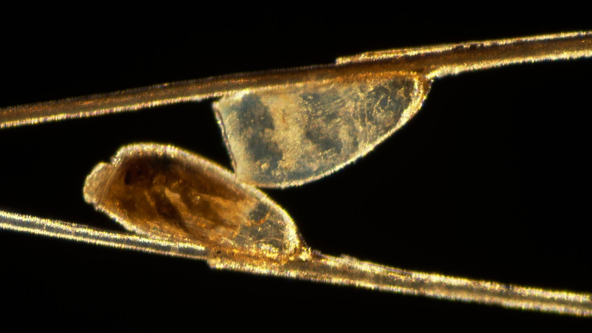 How Common Is Ekbom's Syndrome, or Delusions of Infestation? | National ...