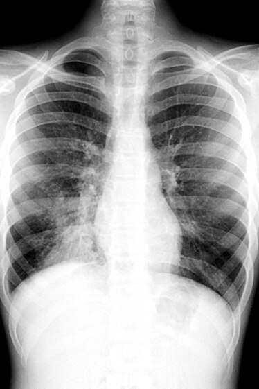 What is white lung syndrome? Here's what to know about pneumonia