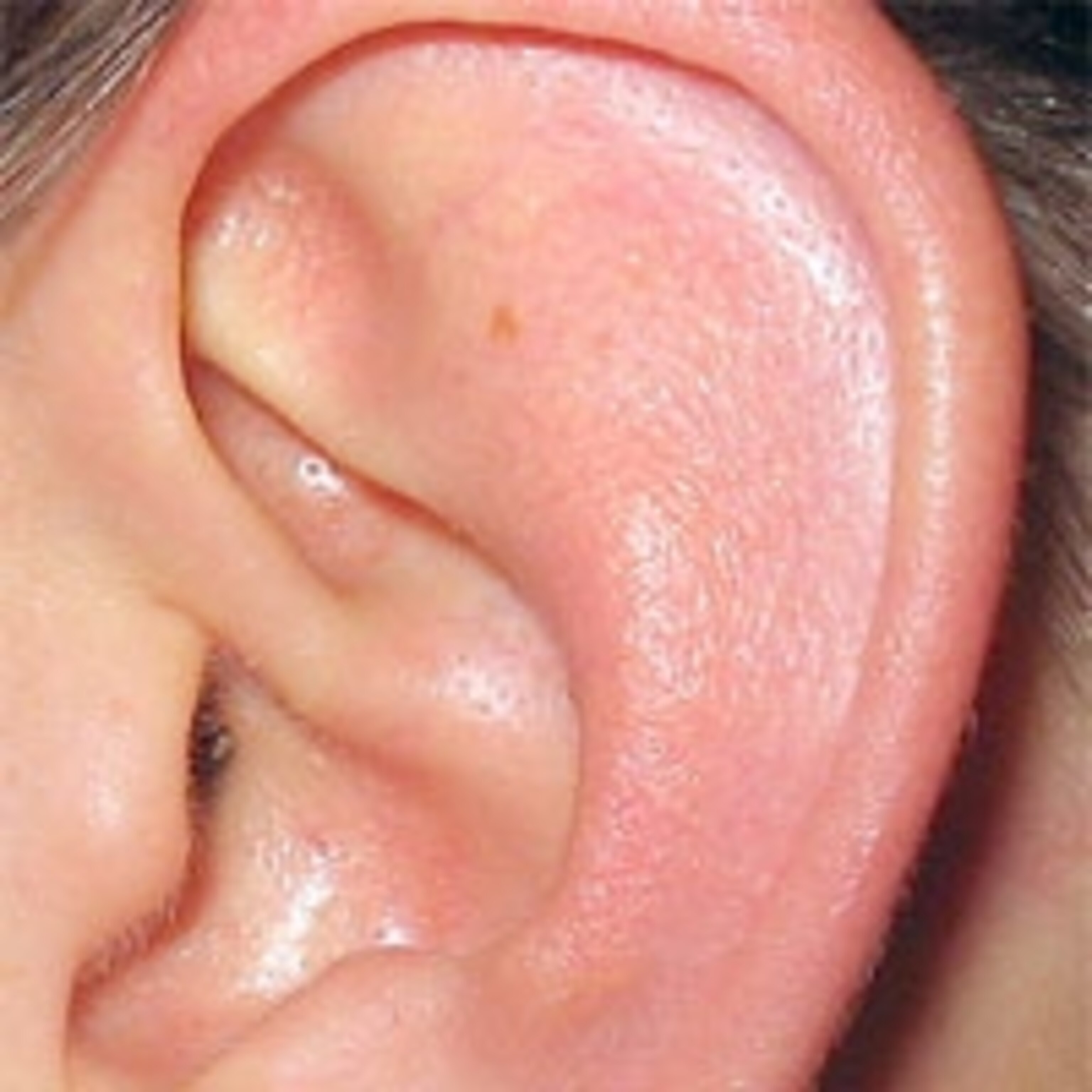 Treating tinnitus with an individually tailored piece of music