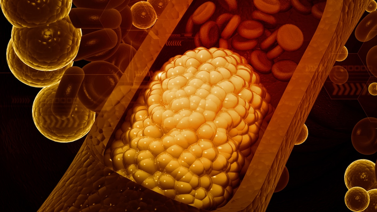 High cholesterol can be inherited. Here's what you can do about it ...