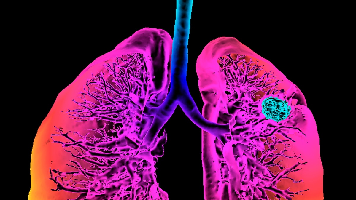 What we're learning from lung cancer patients who never smoked ...
