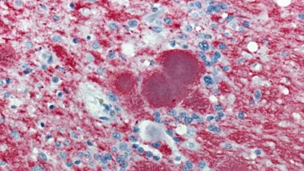 Prions enter stealth mode in the spleen, causing silent infections ...