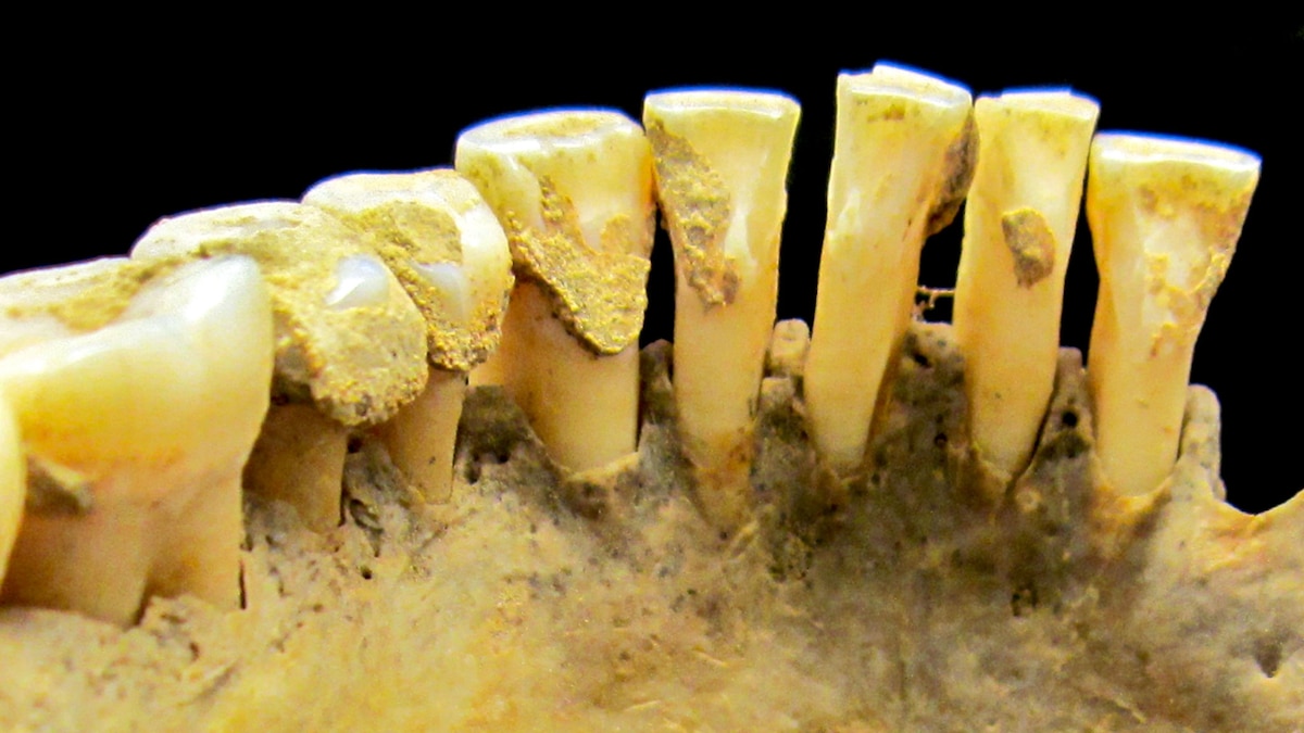 Tooth Plaque May Hold Clues About Ancient Life | National Geographic
