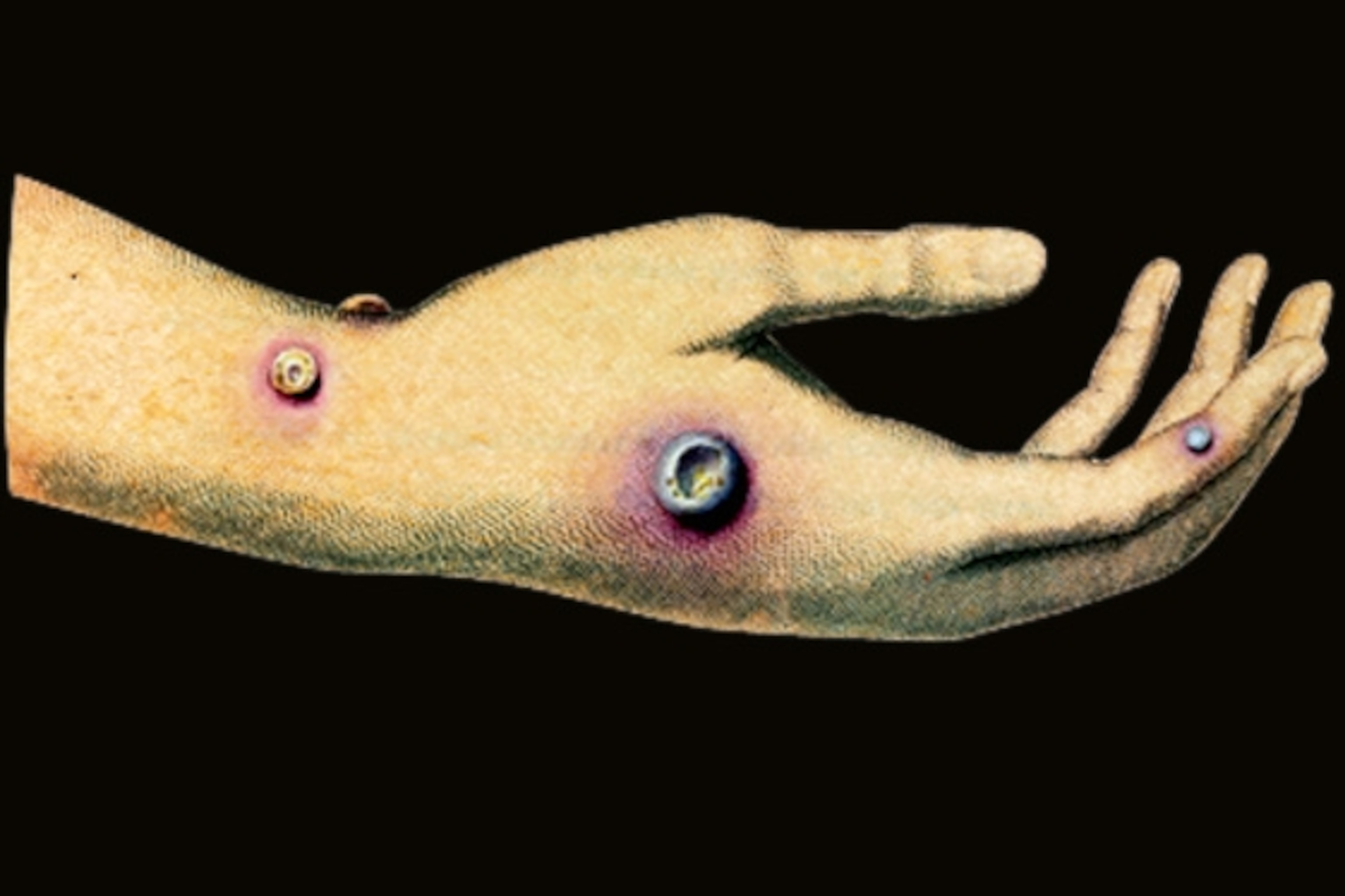 How the first vaccines defeated smallpox