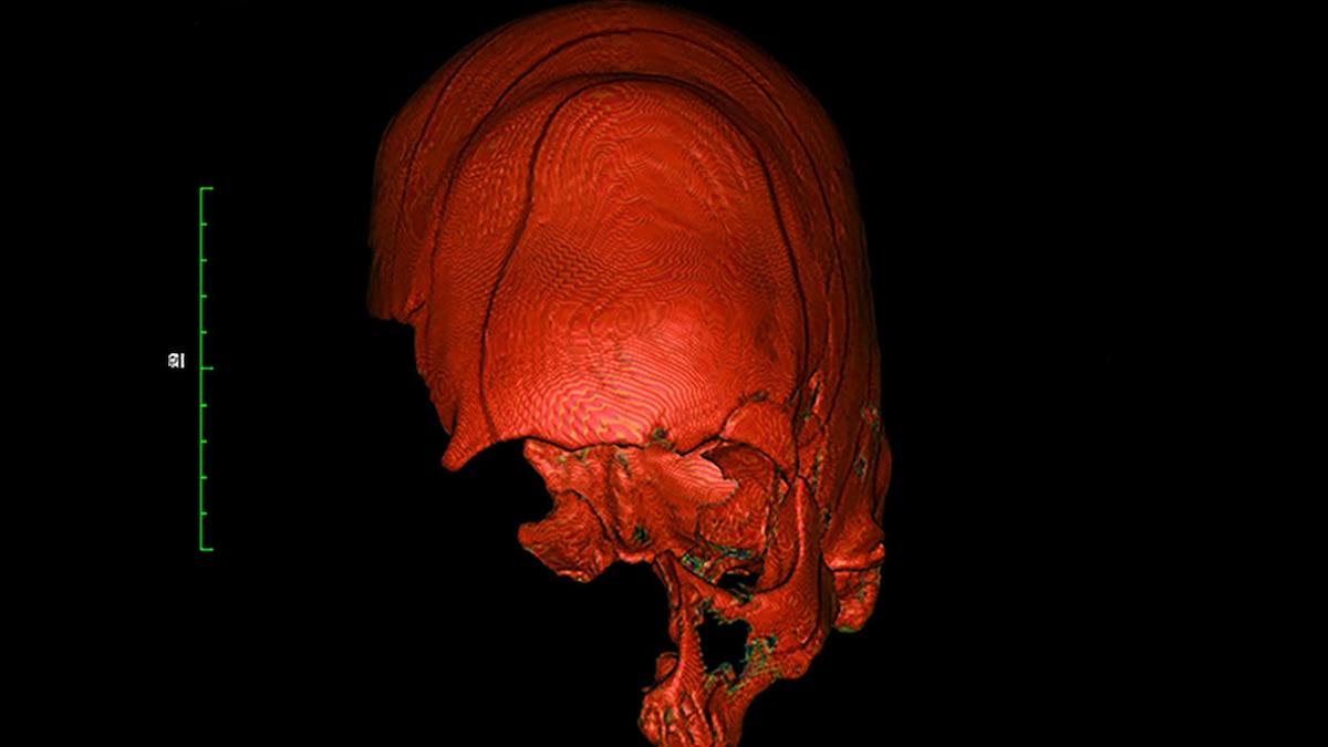 Can DNA solve the mystery of Europe’s pointy skulls? | National Geographic