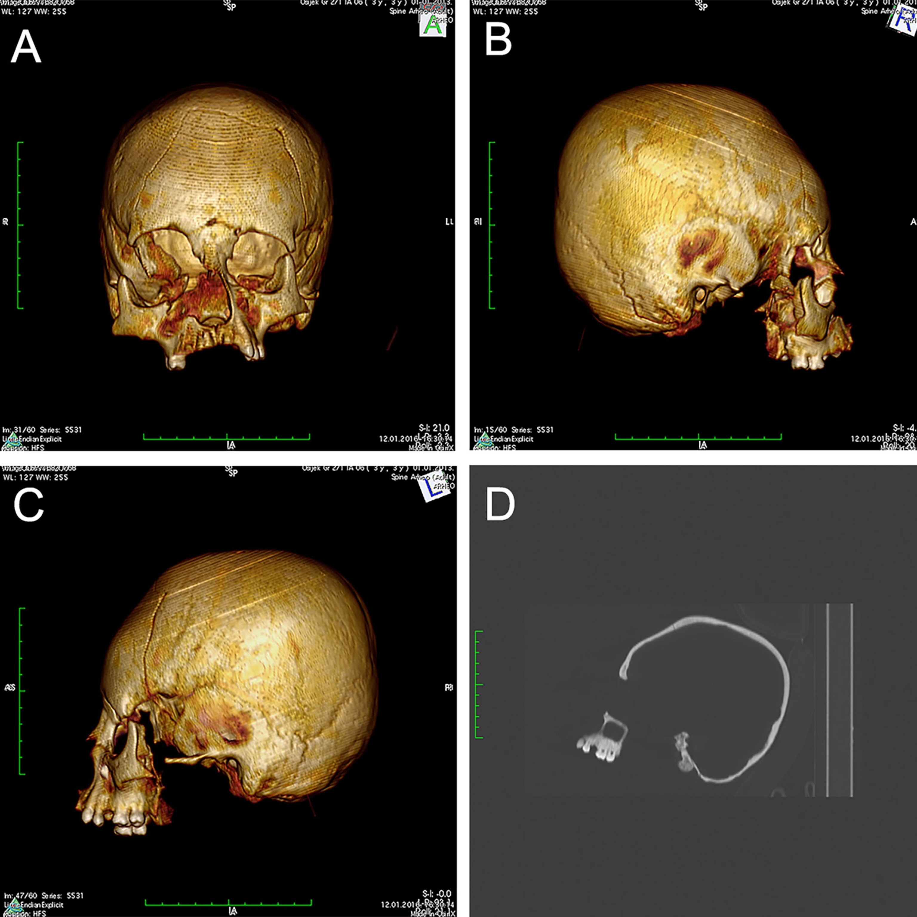 Can DNA solve the mystery of Europe’s pointy skulls?