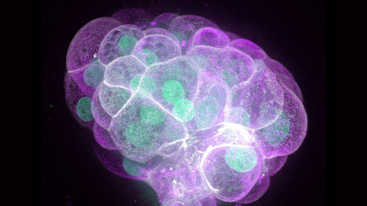 Will a new colon cancer blood test replace your colonoscopy? | National ...