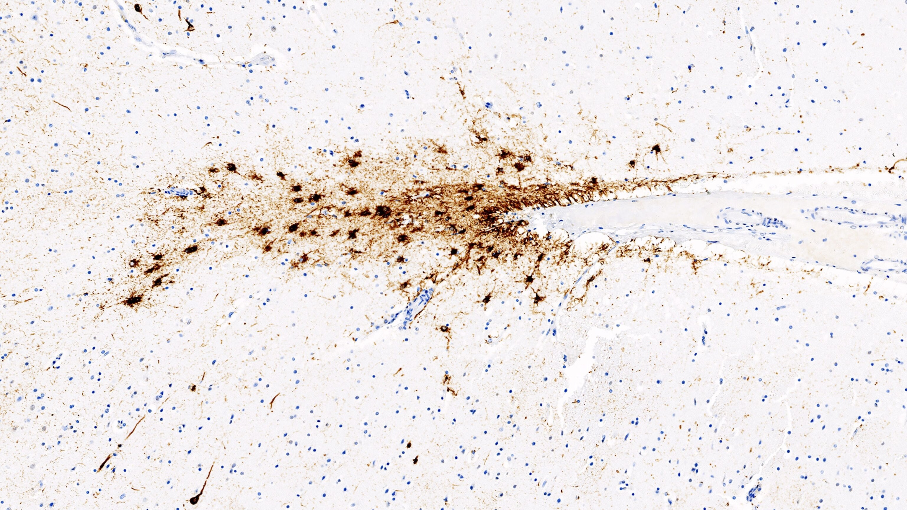 'Shell Shock'—The 100-Year Mystery May Now Be Solved