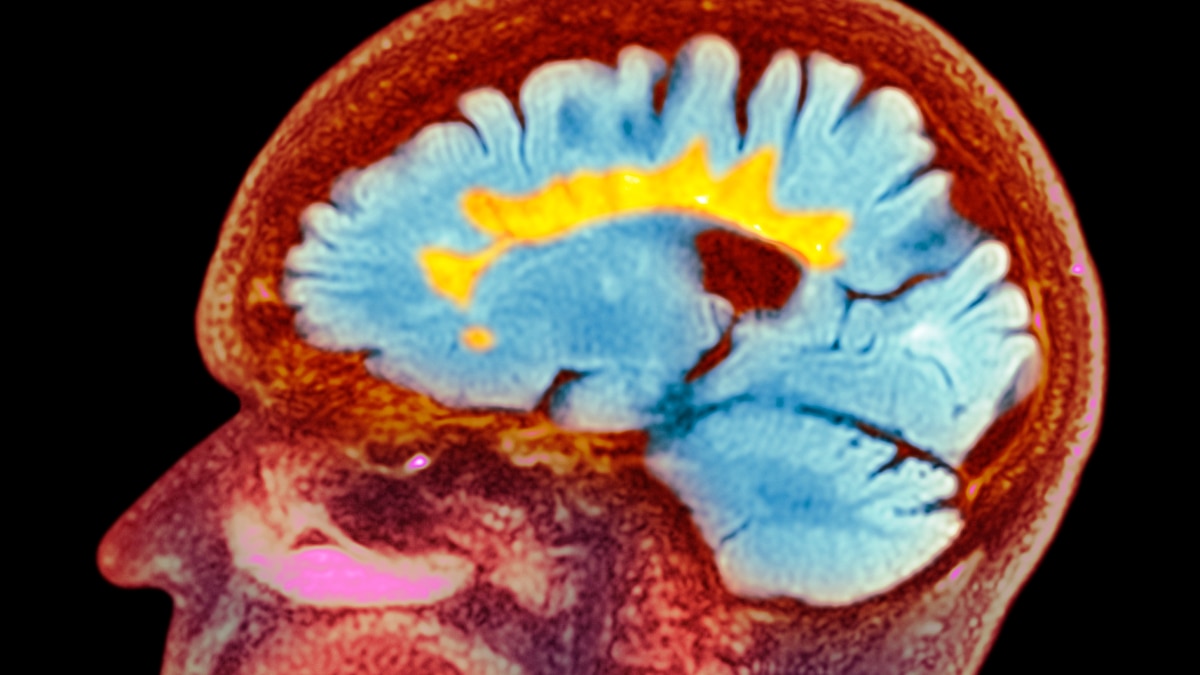 What causes multiple sclerosis—and why are women more at risk ...