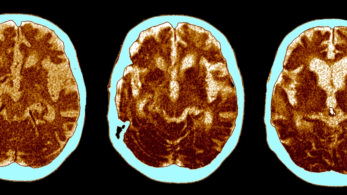 The curious link between Alzheimer’s disease and cancer | National ...