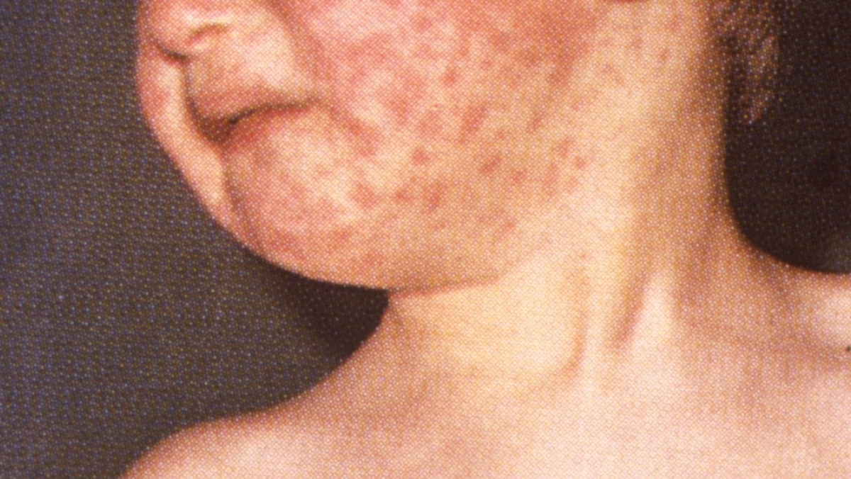 First Measles Death in US Since 2003 Highlights the Unknown Vulnerables ...