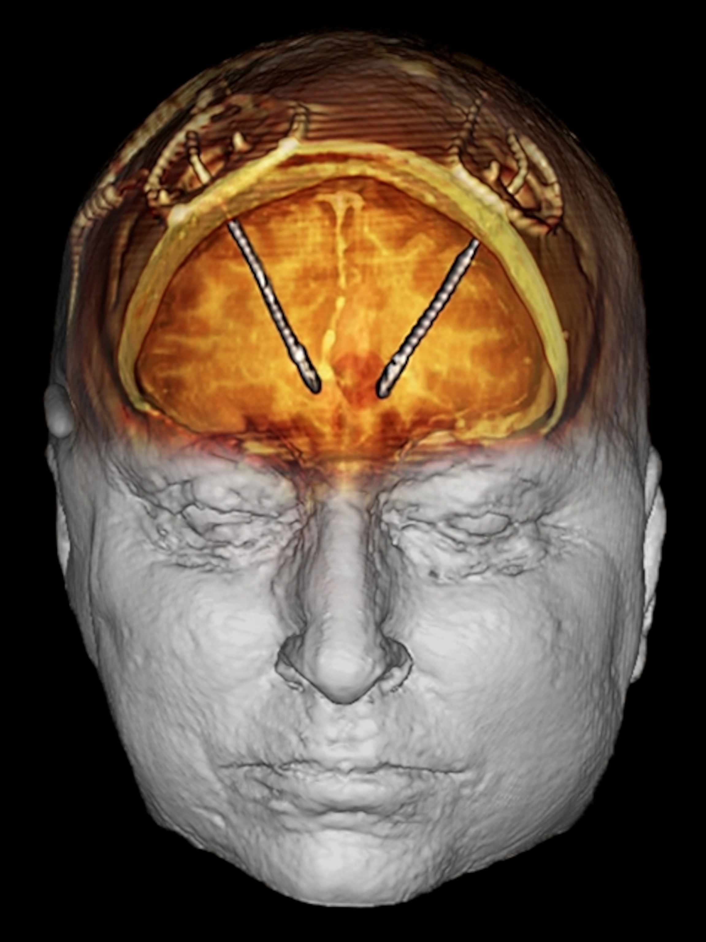 Scientists are unraveling the mysteries of pain