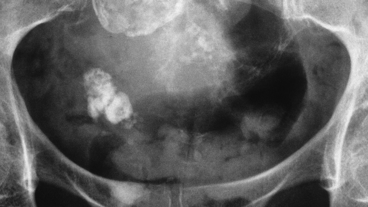 You can't detox your uterus—debunking popular myths about PCOS ...