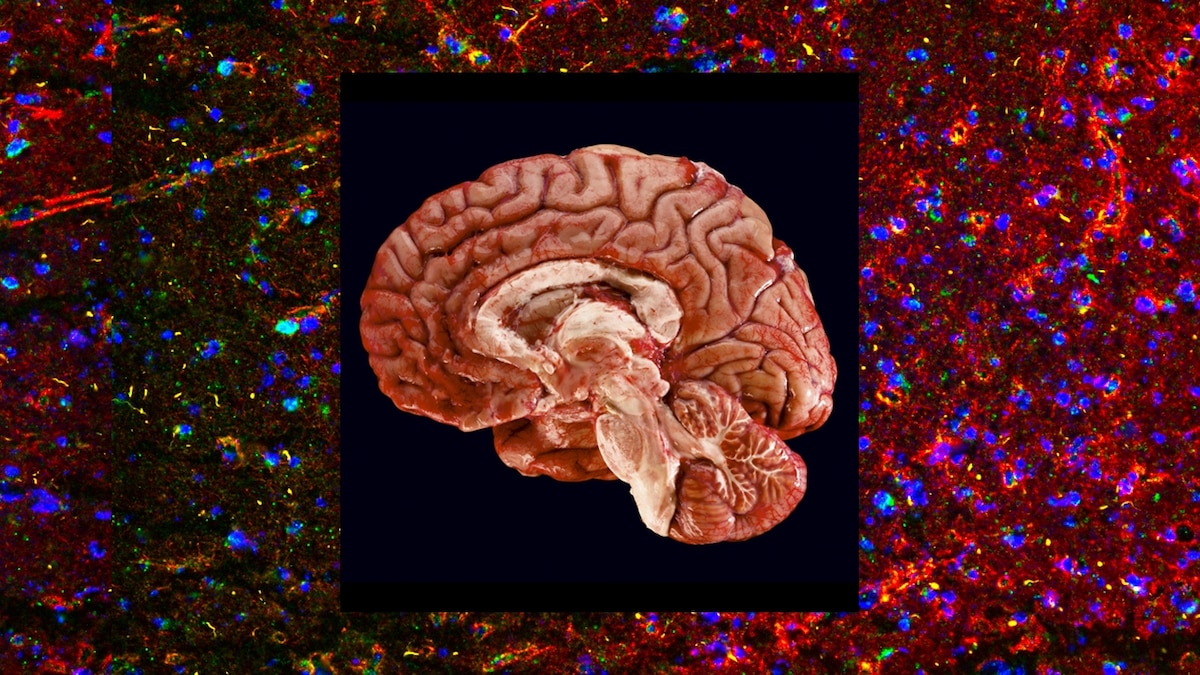 ‘Zombie cells’ could hold the secret to Alzheimer’s cure | National ...