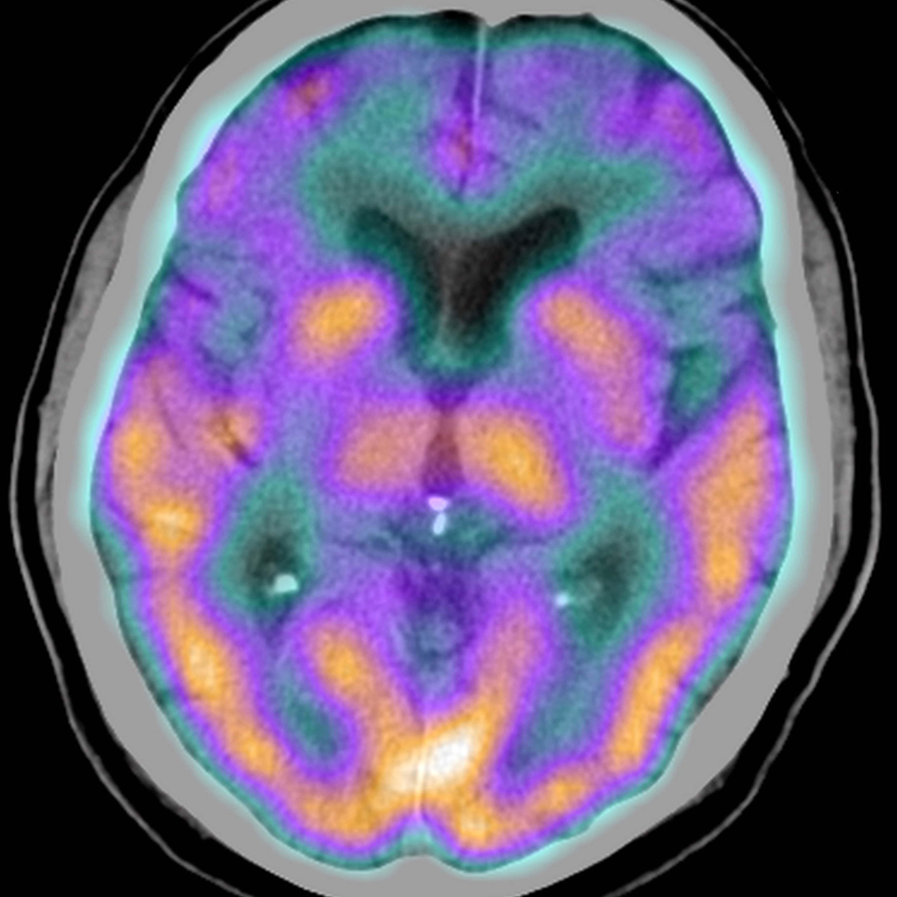 Can ending inflammation help win our battle against depression?