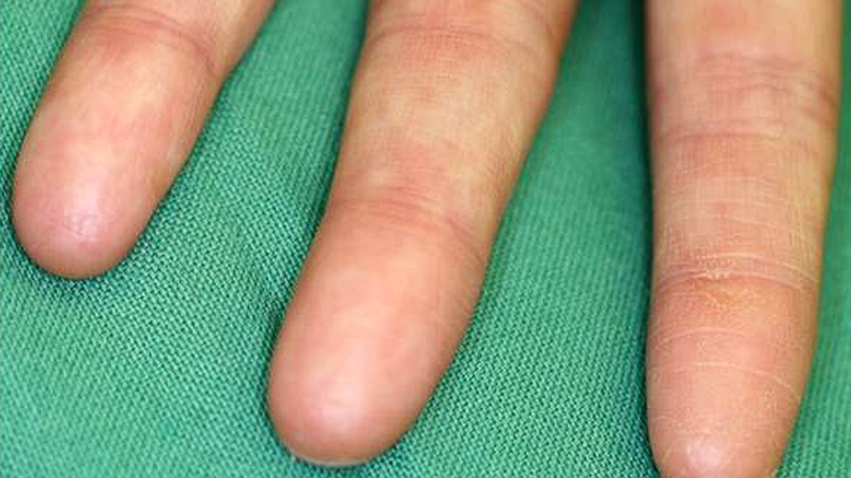 Mutated DNA Causes No Fingerprint Disease mutated-dna-causes-no-fingerprint-disease