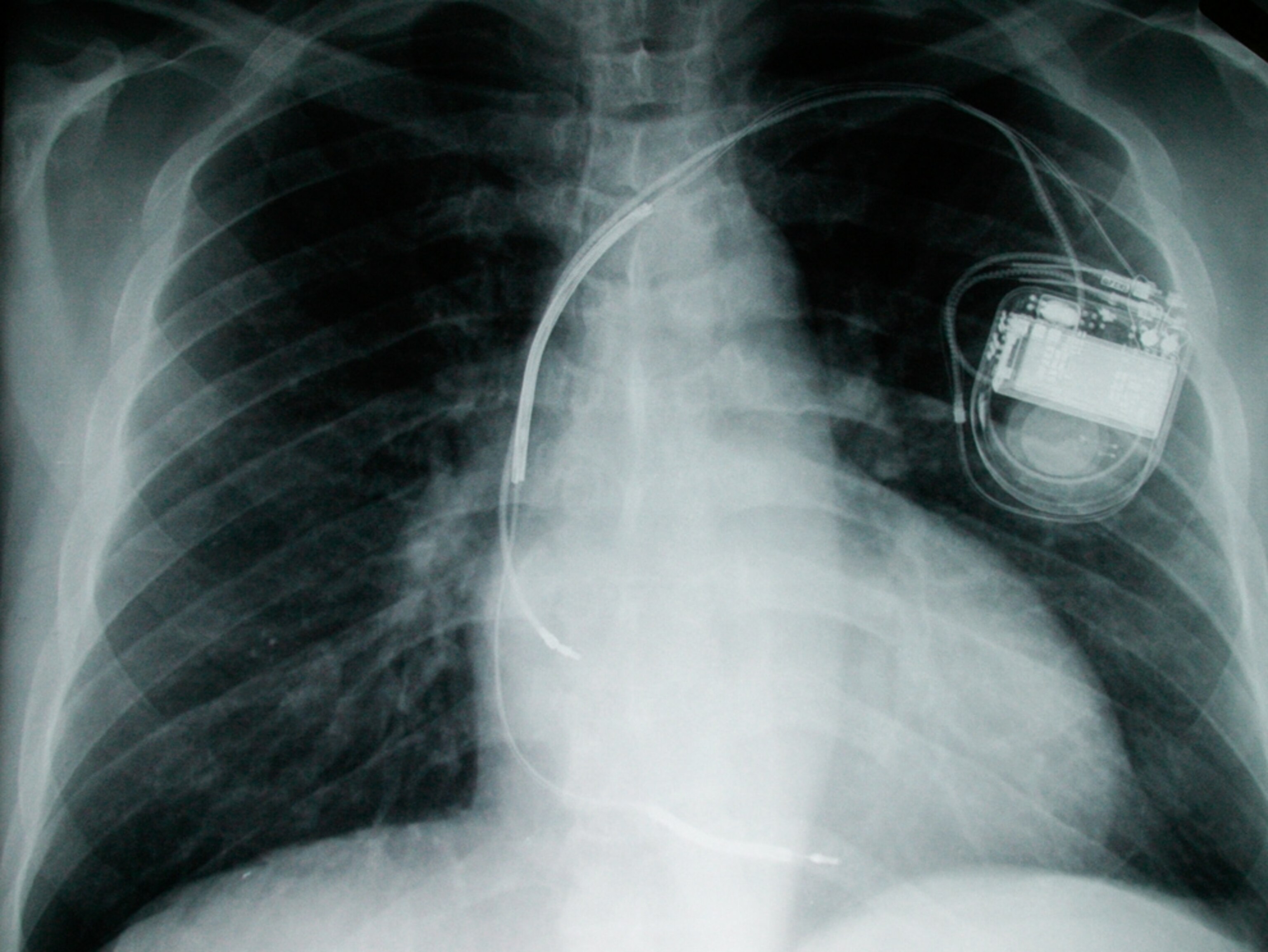 Implanted Fuel Cell Powered by Rat's Body Fluids