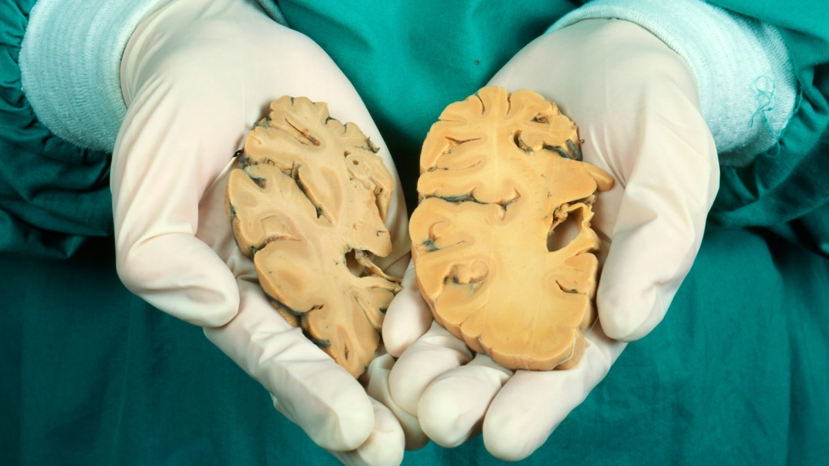 Alzheimer’s drug FDA approval spurs optimism—and some caution ...